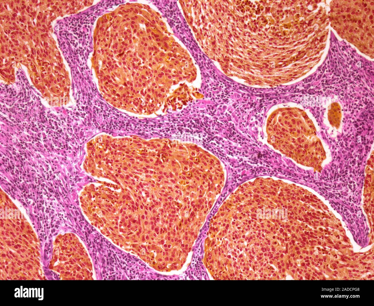 Il cancro cervicale. Micrografia di luce (LM) di una sezione di un carcinoma a cellule squamose ...