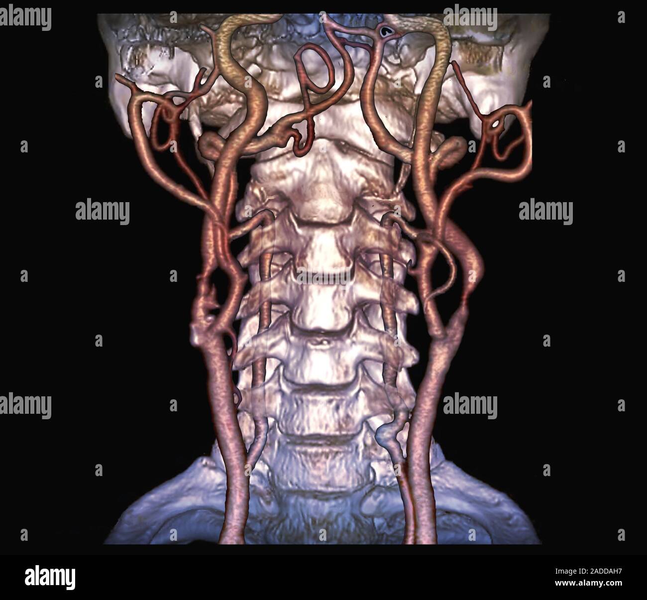 L'aterosclerosi nelle arterie del collo. 3D colorato tomografia ...
