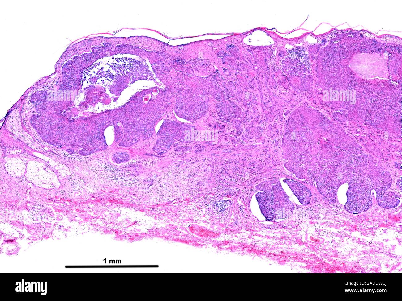 Il carcinoma a cellule basali, micrografia di luce. Cellula basale ...