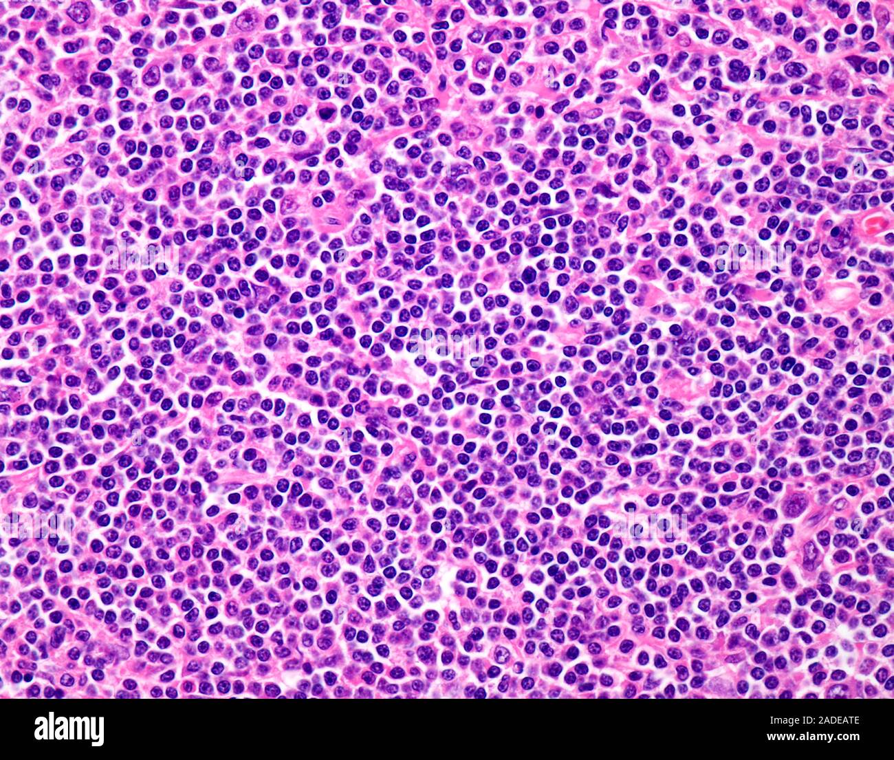 Piccolo linfoma linfocitica, micrografia di luce. B-cell leucemia ...