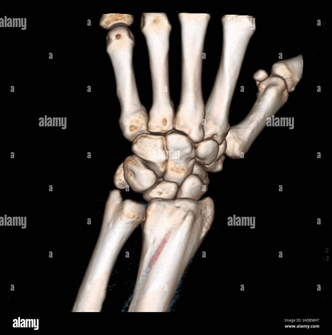 Polso normale. 3-dimensionale di tomografia computerizzata (CT) la ...