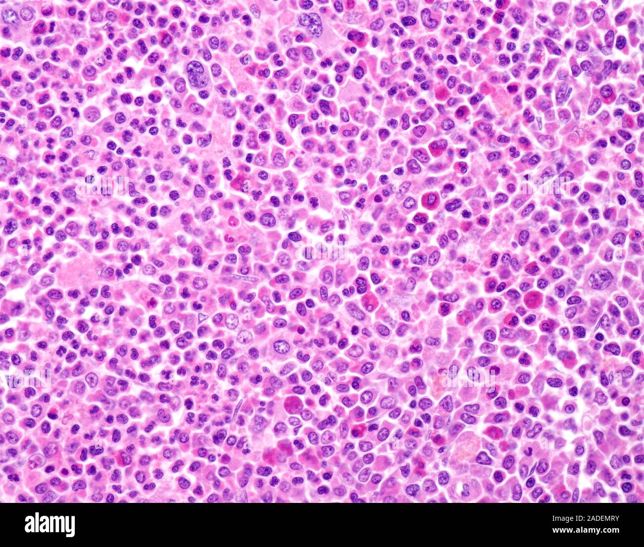 Sarcoma mieloide, micrografia di luce. Sarcoma mieloide è un tumore ...