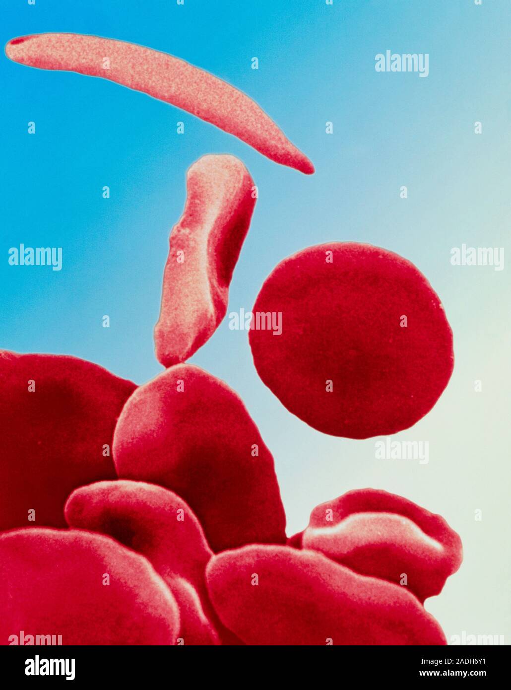 Anemia falciforme. Color scanning electron microfotografia (SEM) di ...