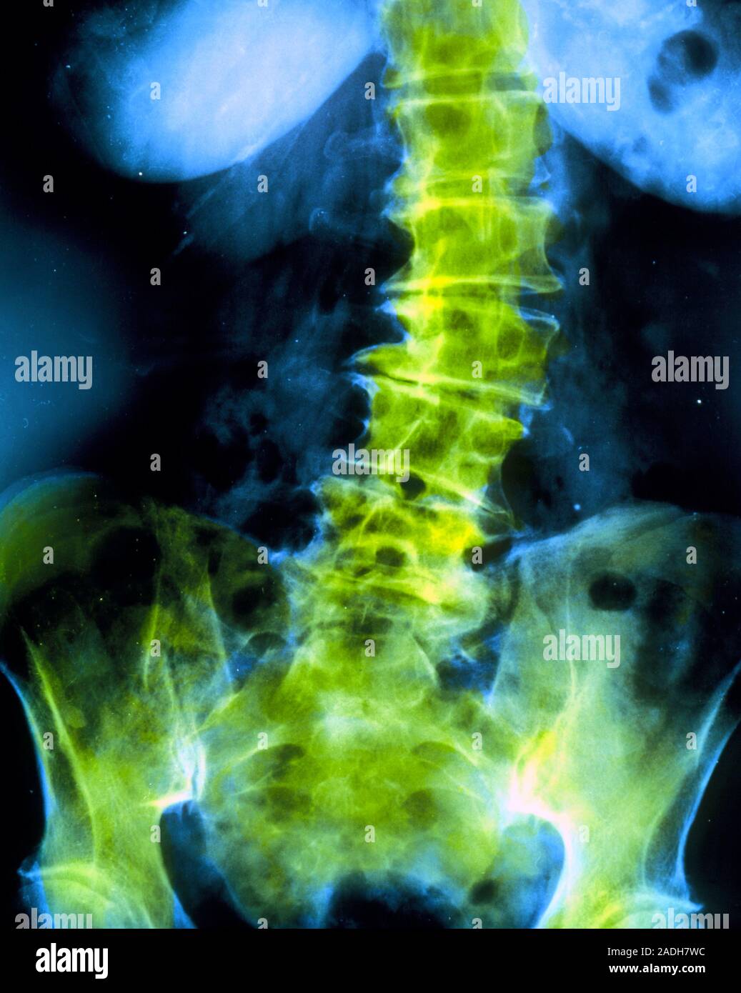 Falso colore X-ray del rachide lombare di una donna di 80 anni, che ...