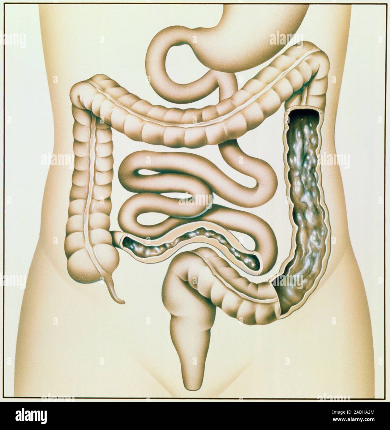 Il morbo di Crohn e la colite ulcerosa. Illustrazione del tubo ...