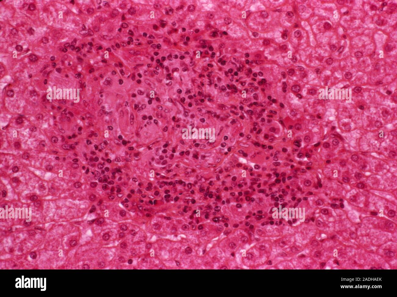 Cirrosi epatica. Micrografia di luce di una sezione attraverso un ...
