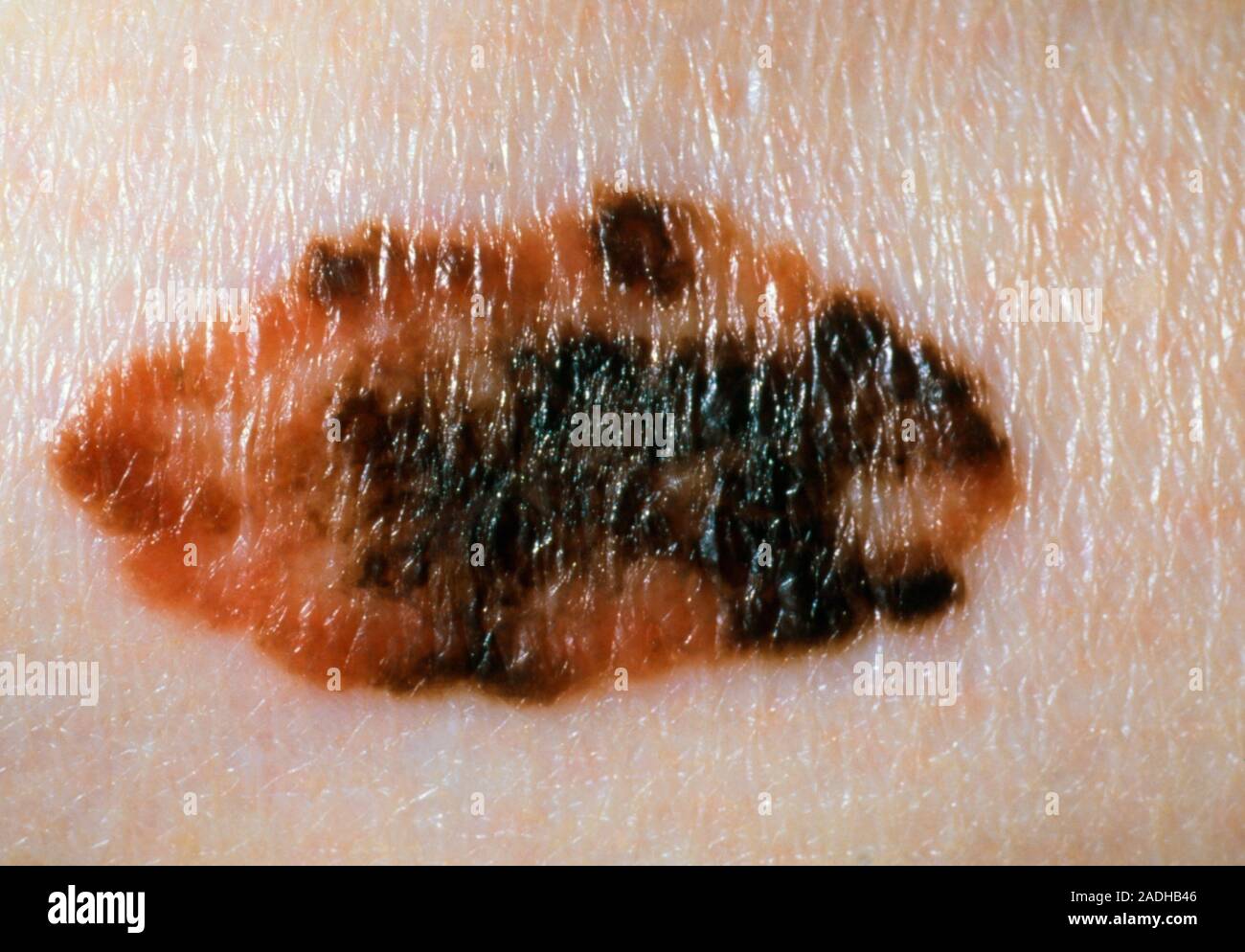 Il melanoma.Close-up di un melanoma maligno cancro della pelle. I ...