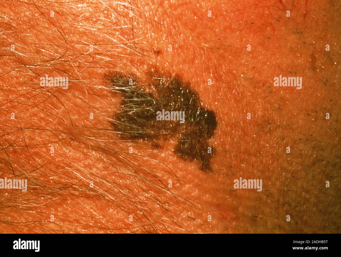 Il melanoma. Close-up di un melanoma maligno cancro della pelle. I ...