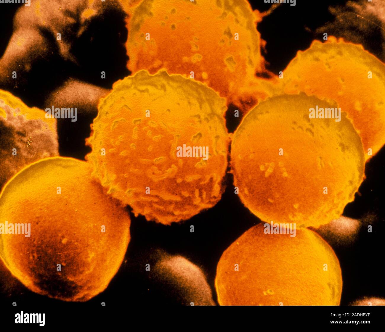 La leucemia. Falso-color scanning electron microgr- aph di cellule ...