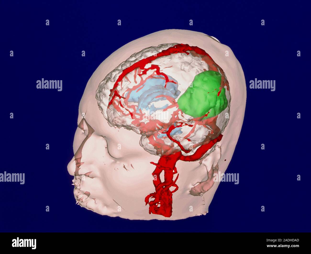 Tumore del cervello. Colorato 3-D imaging a risonanza magnetica (MRI) scansione di un paziente ...