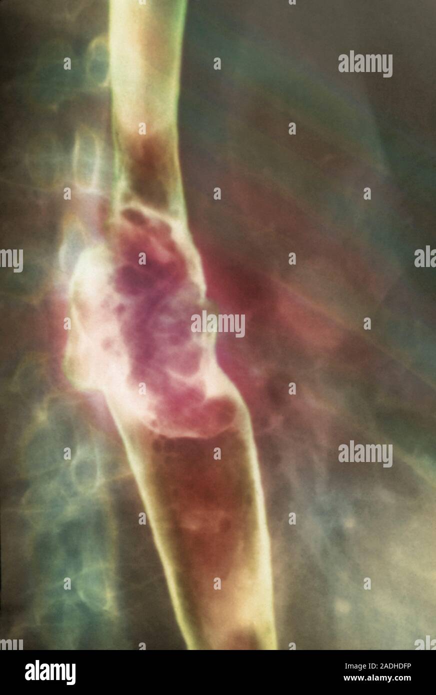 Esophagus cancer. Colorato X-ray di un tumore (bianco/rosa) sull ...