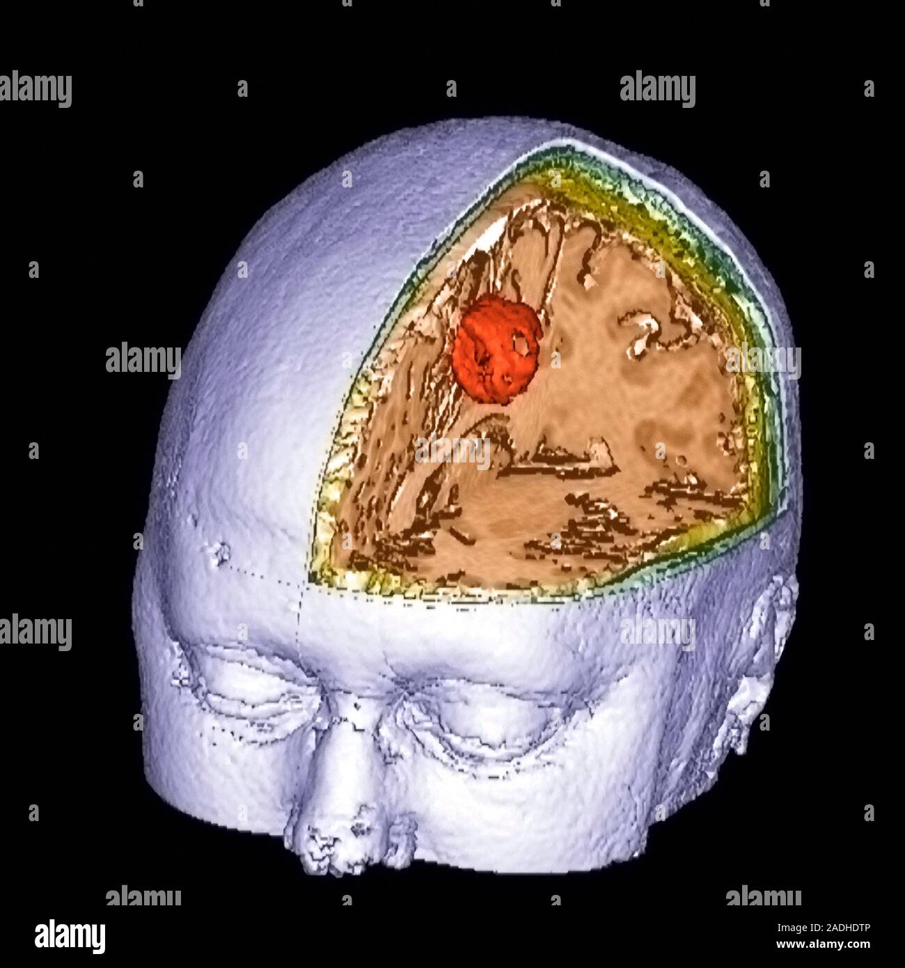 Tumore del cervello. Colorato modello tridimensionale di una testa 43 anno vecchia donna ...