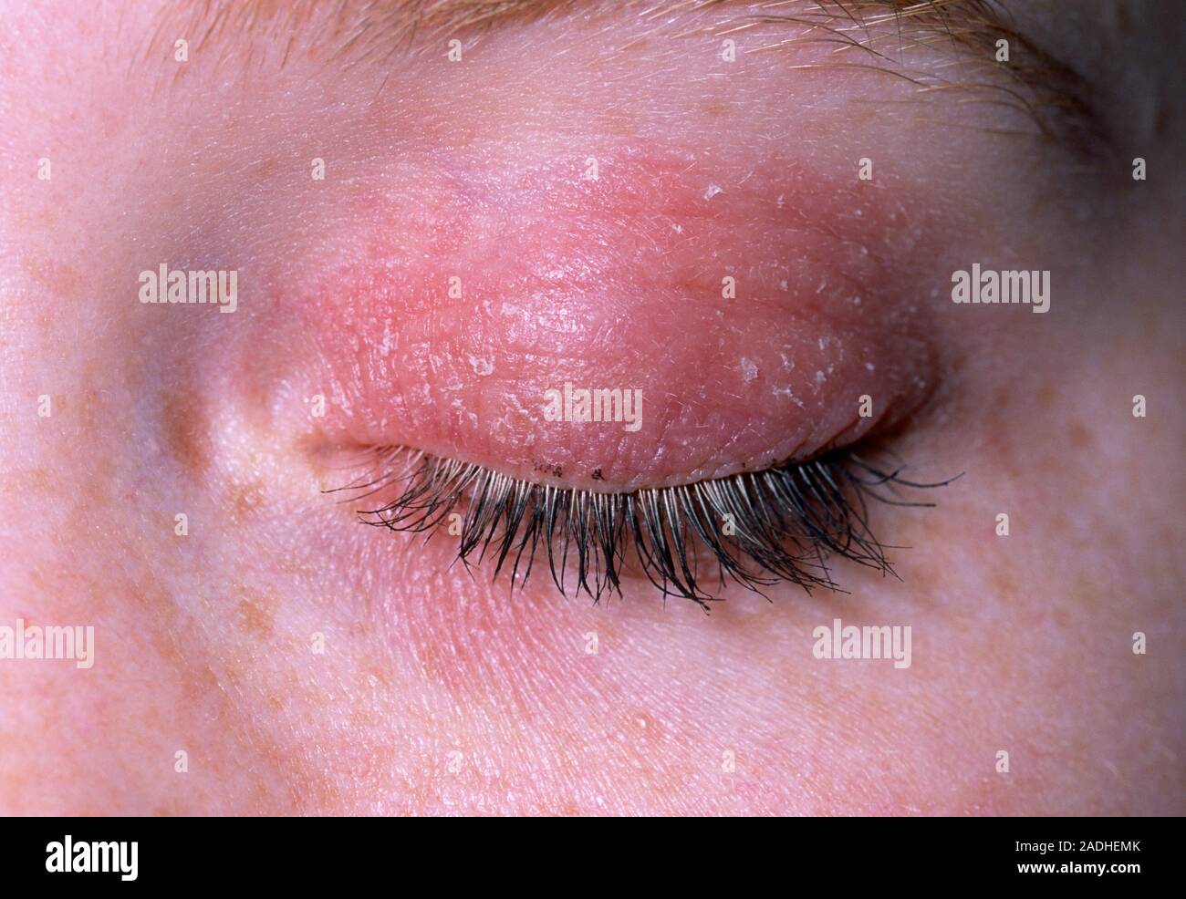 Eczema sulle palpebre. Close-up di un eczema eruzioni cutanee su la ...