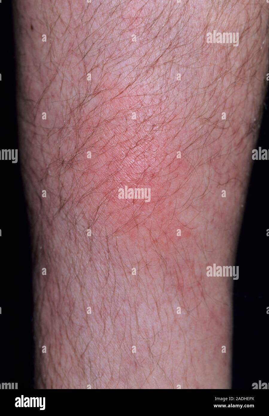 Gambe gonfie. Eritema nodoso (rosso gonfiore) sulla parte inferiore ...