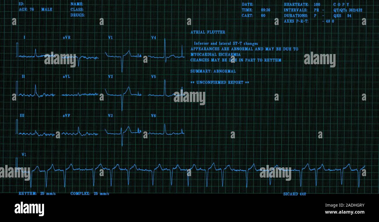 La malattia di cuore. Elettrocardiogramma (ECG) del battito cardiaco di ...