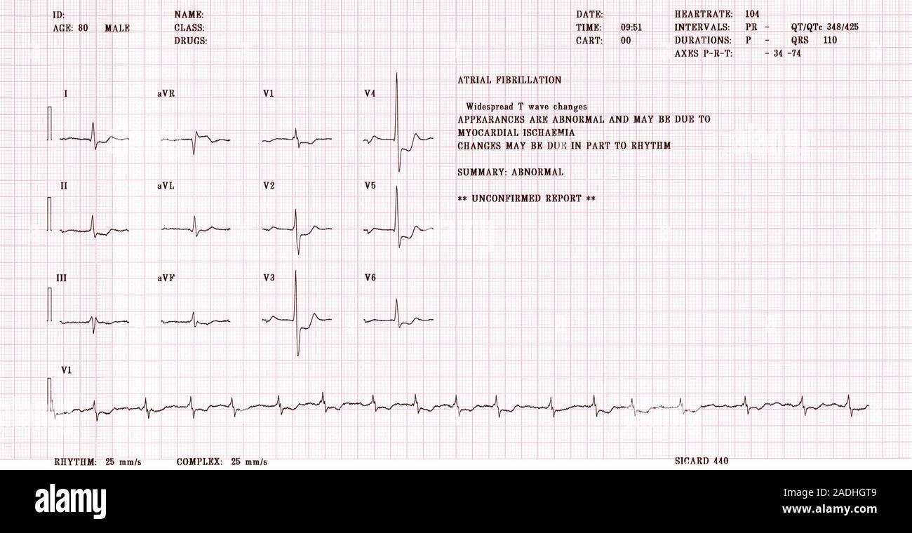 La malattia di cuore. Elettrocardiogramma (ECG) che mostra il battito ...