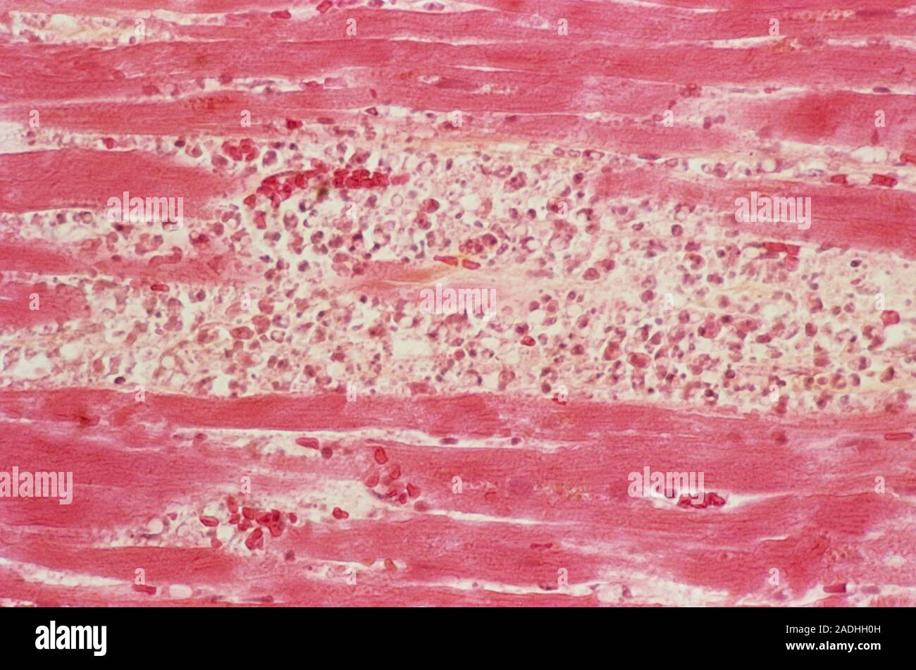 Infiammazione del muscolo cardiaco. Micrografia di luce di una sezione ...