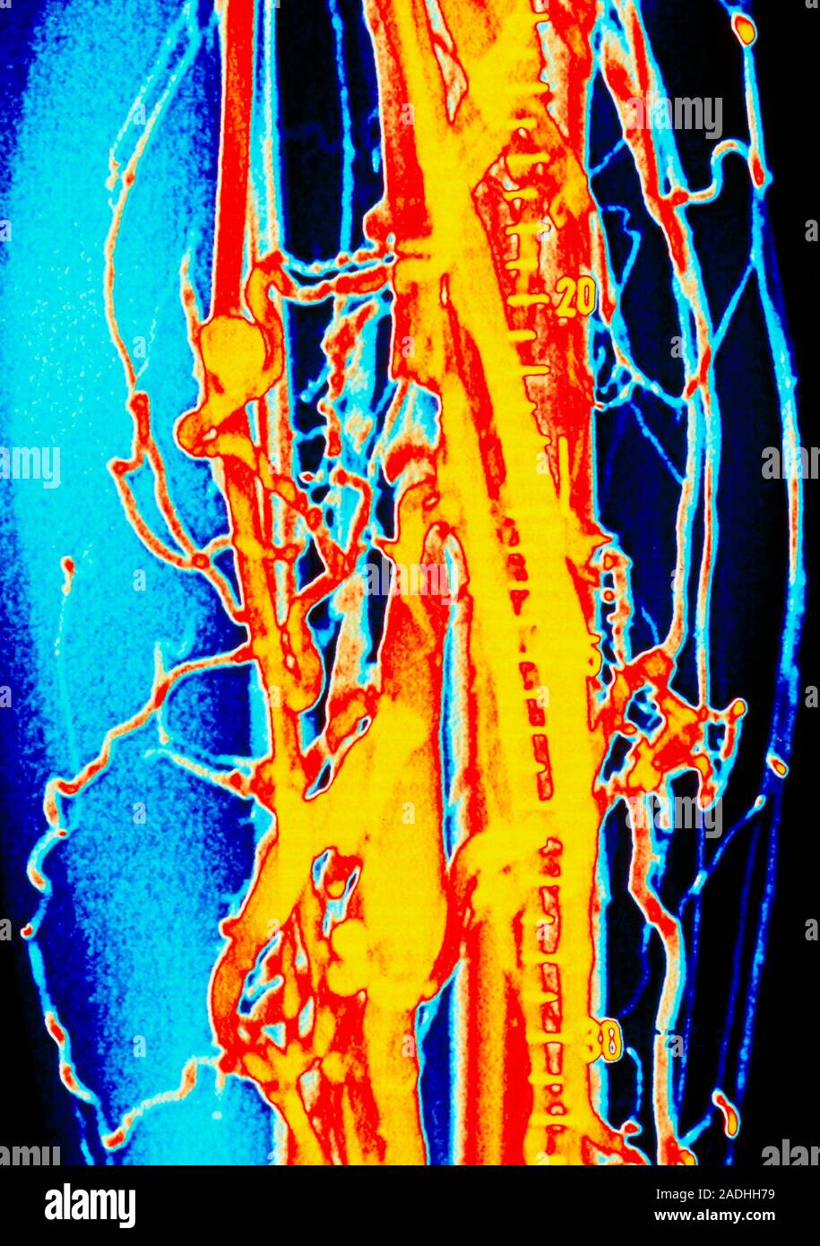 Flebite. Venogram colorati (X-ray) mostrante l'infiammazione di vene ...