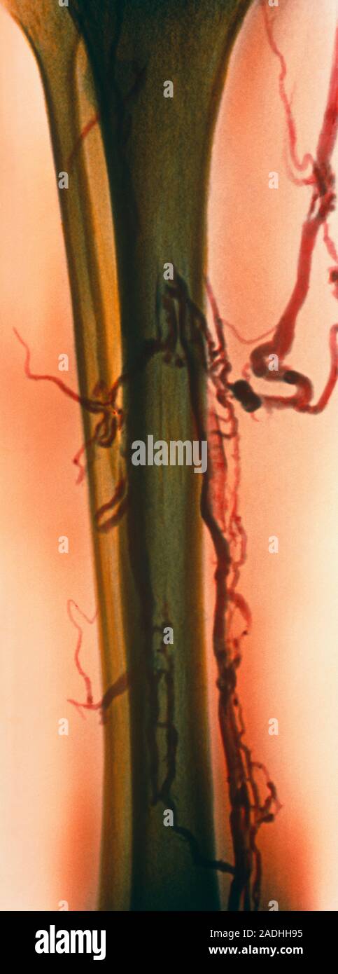 La trombosi. Venogram colorati (X-ray) mostra la trombosi venosa ...