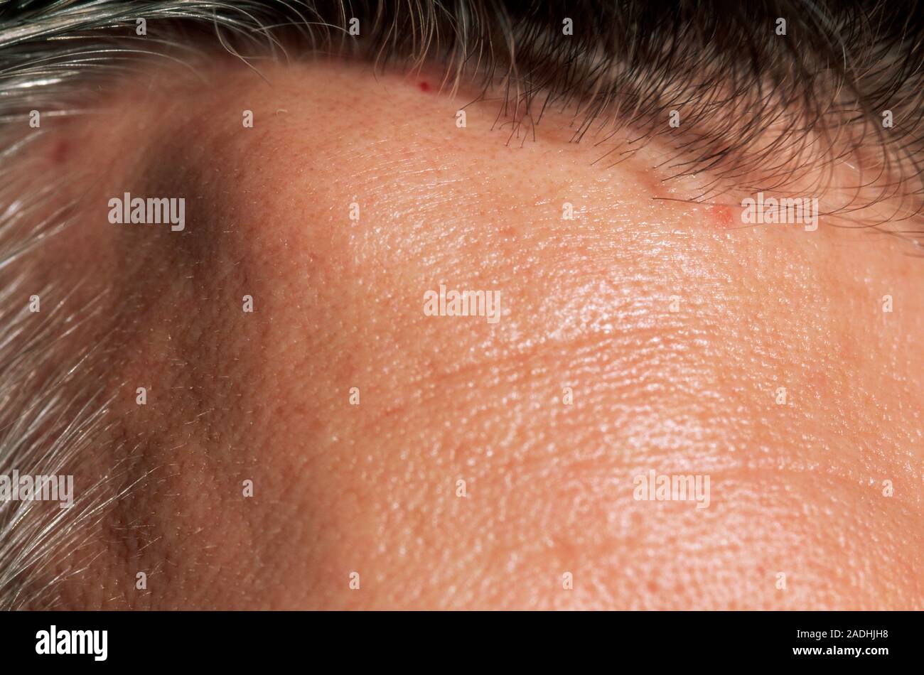 Lipoma sulla fronte di un 46-anno-vecchio uomo. Lipoma è un tumore ...