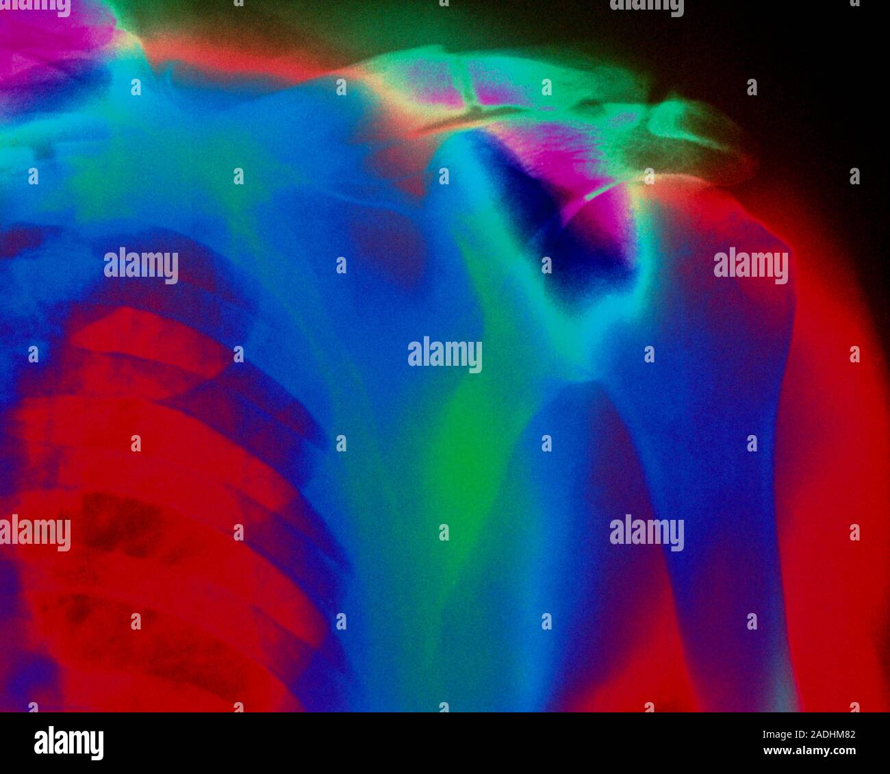 Il morbo di Paget frattura. Colorato X-ray mostra una clavicola ...