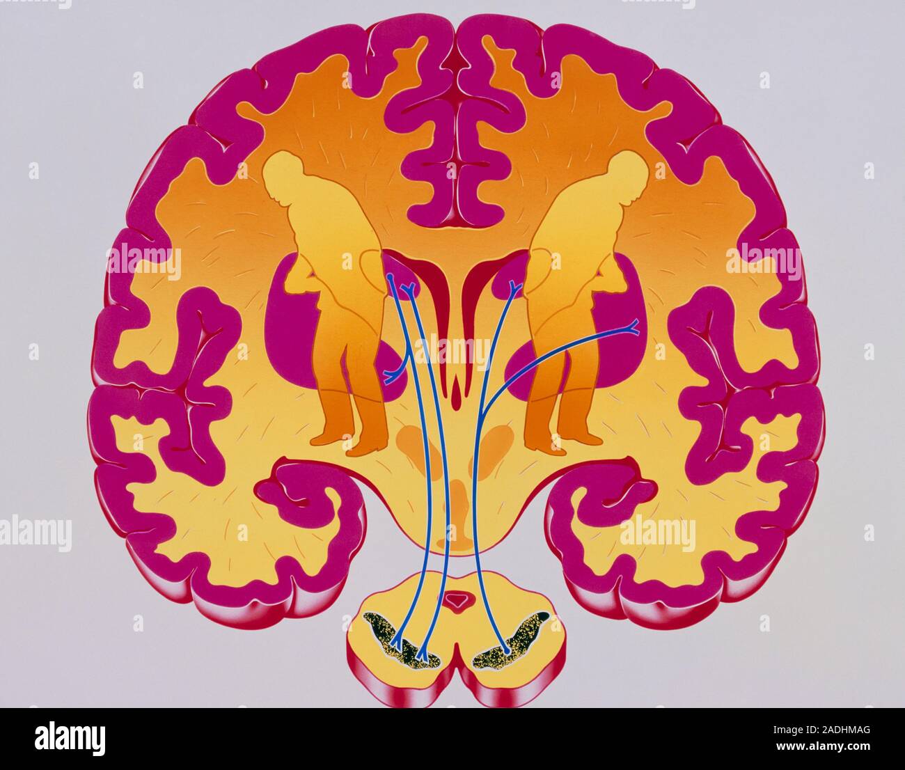 Il morbo di Parkinson. Illustrazione del cervello, raffigurante il ...