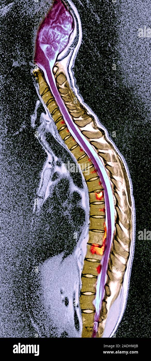 Morbo di Pott. Colorato X-ray della colonna vertebrale di un paziente ...