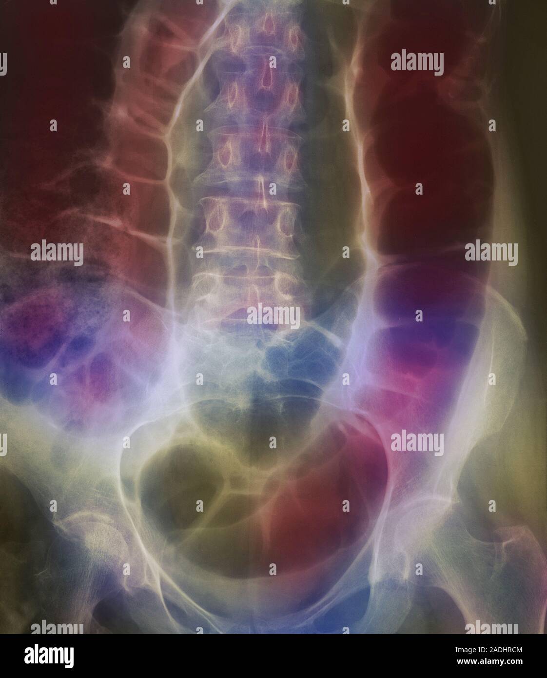 Twisted colon. Colorato X-ray dell'addome di un paziente con un twisted ...