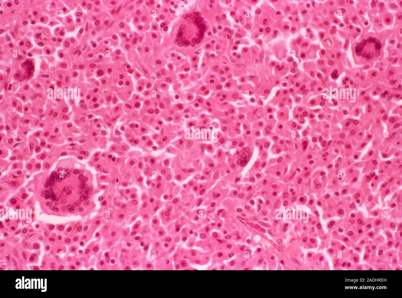 Tumore della pelle. Micrografia di luce di una sezione attraverso un ...