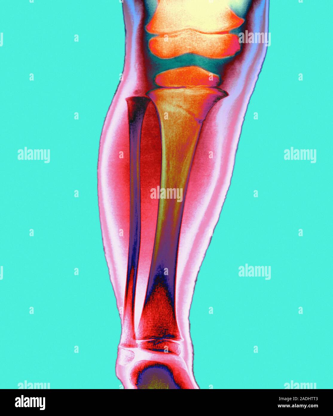 Frattura della gamba. Colorato X-ray di una gamba fratturata. La linea ...