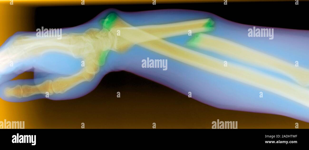 Rotto il braccio e slogato polso. Colorato X-ray mostra una frattura ...