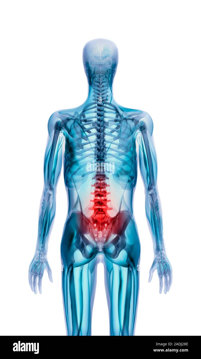 Dolore alla schiena. X-ray illustrazione della vista posteriore di uno ...