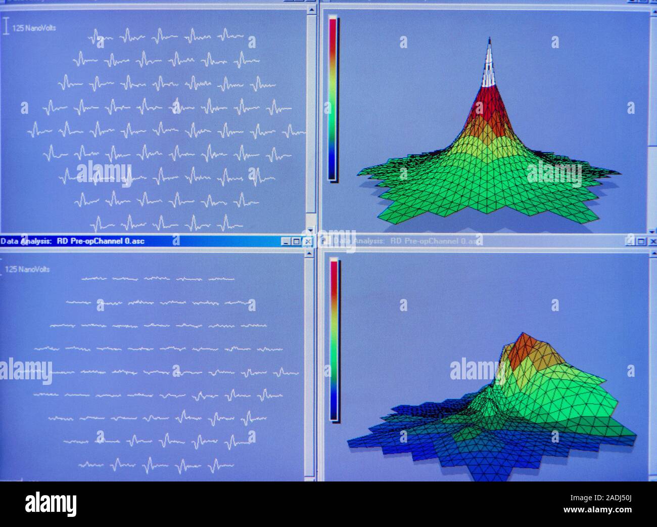 Electroretinograms. Lo schermo di visualizzazione dei risultati di un ...