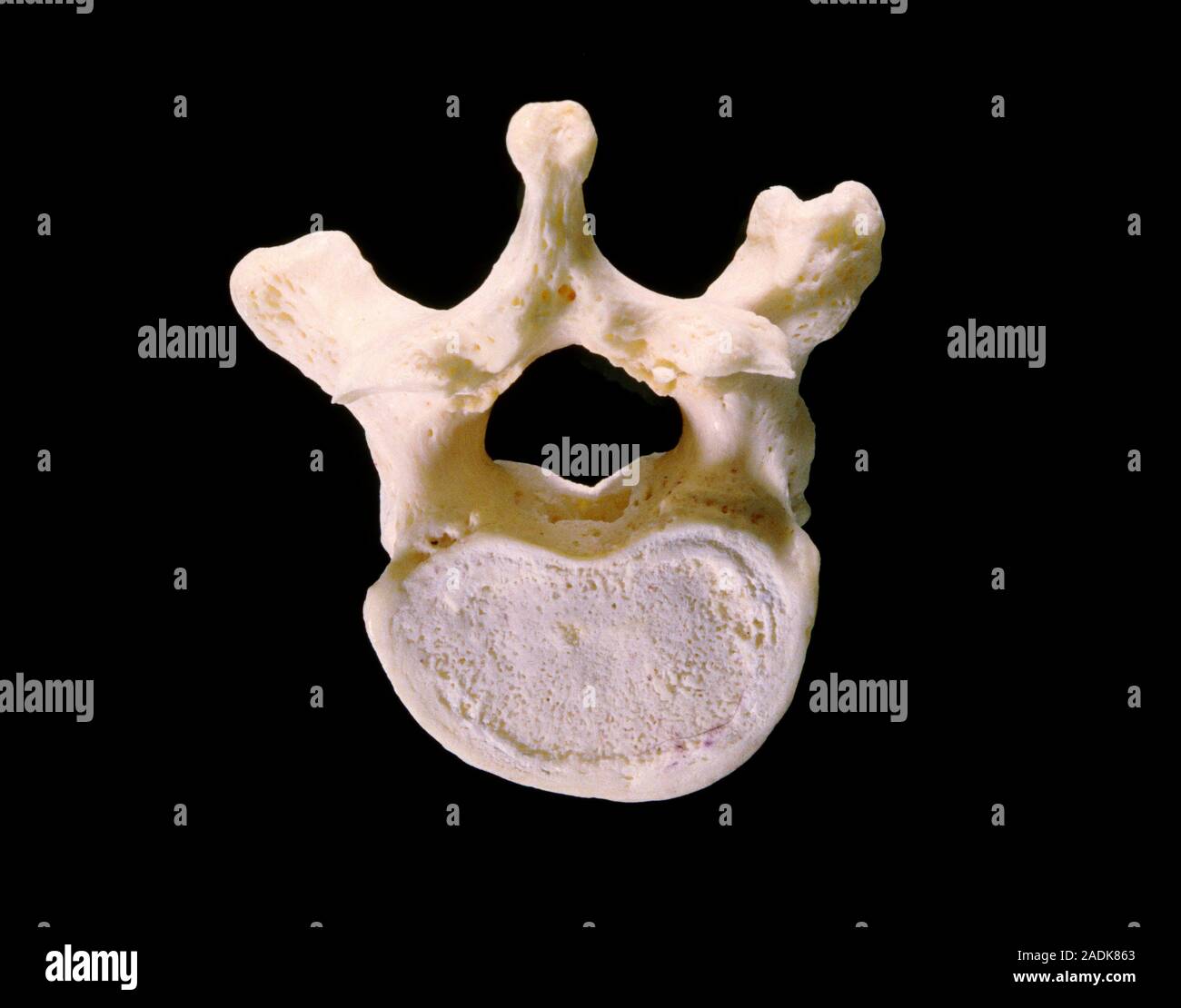 Fotografia dell'umano prima vertebra lombare (L1), uno dei cinque ossa ...