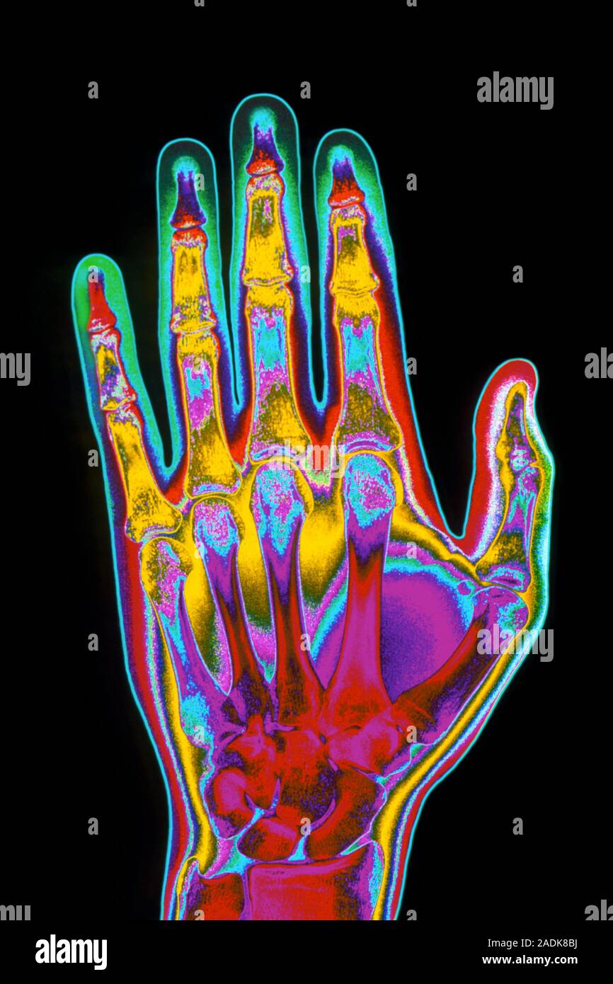 Mano d'uomo. Colorato X-ray della mano sana di un uomo, che mostra la ...