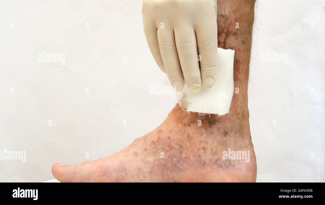 Ulcere alle gambe immagini e fotografie stock ad alta risoluzione - Alamy