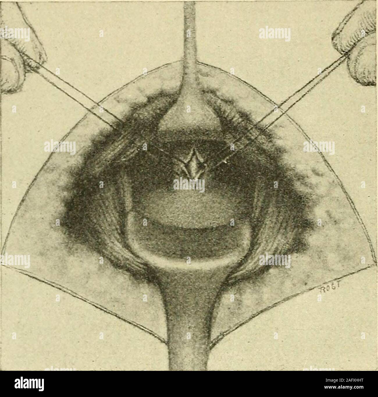 . Studi sulla ipertrofia e cancro della prostata. Fig. 13.-mostra ...