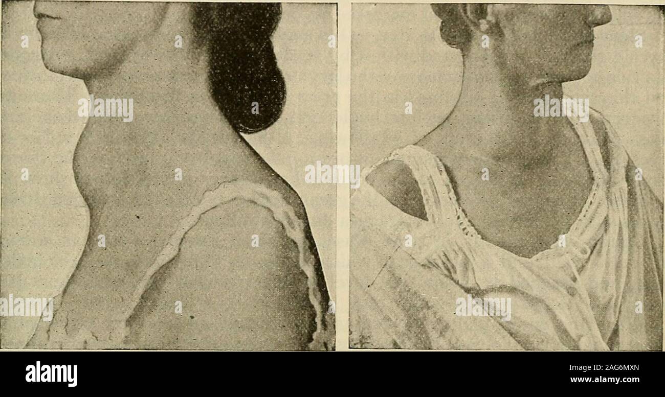 Gozzo endemico immagini e fotografie stock ad alta risoluzione - Alamy