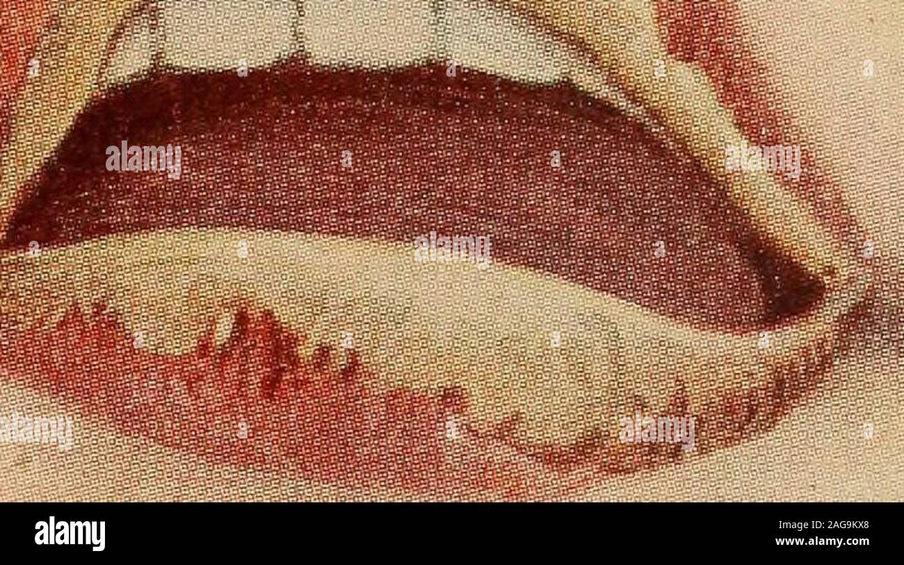 . Le malattie dei bambini. lly leggera. La morte spesso risultati ...