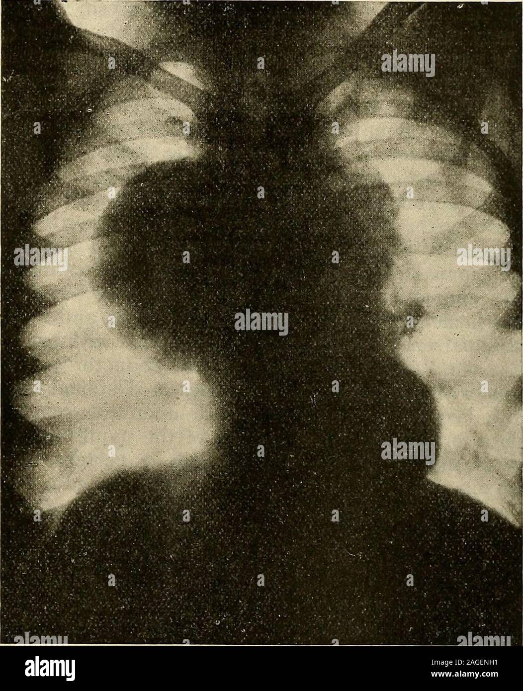 Arteria brachiale destra immagini e fotografie stock ad alta ...