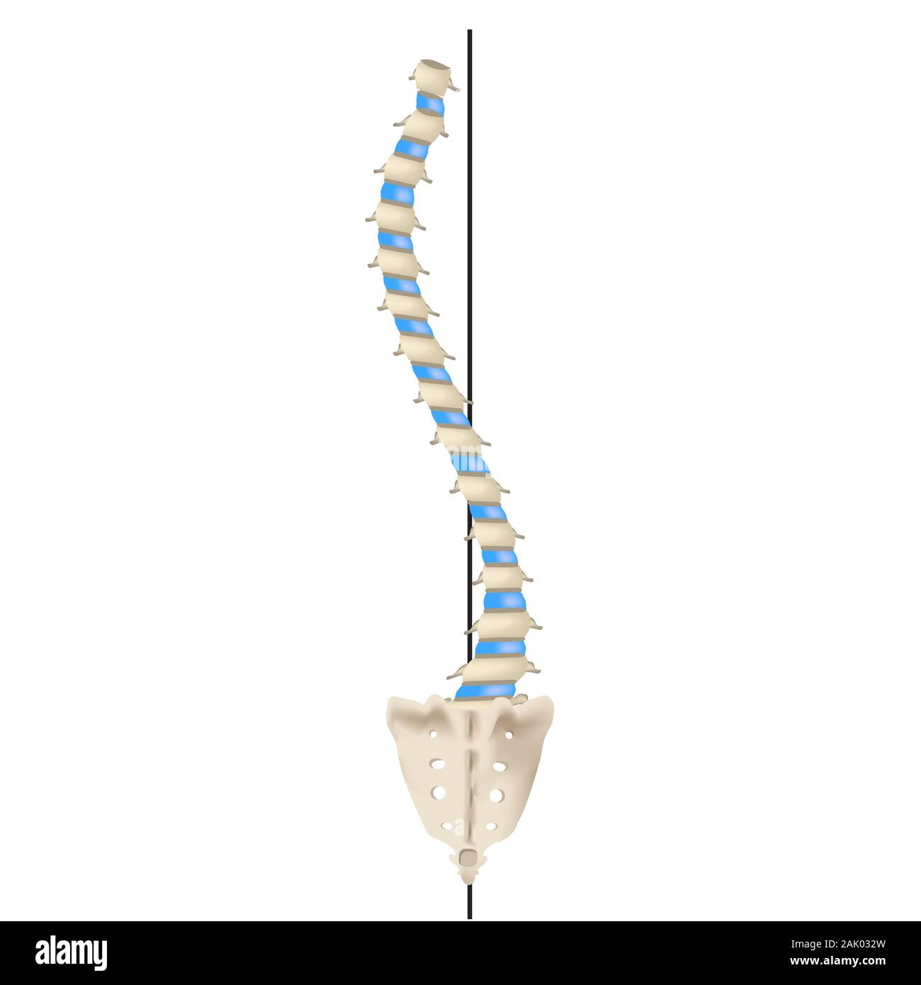 A forma di S la scoliosi. Dextroscoliosis. Levoscoliosis. Curvatura ...