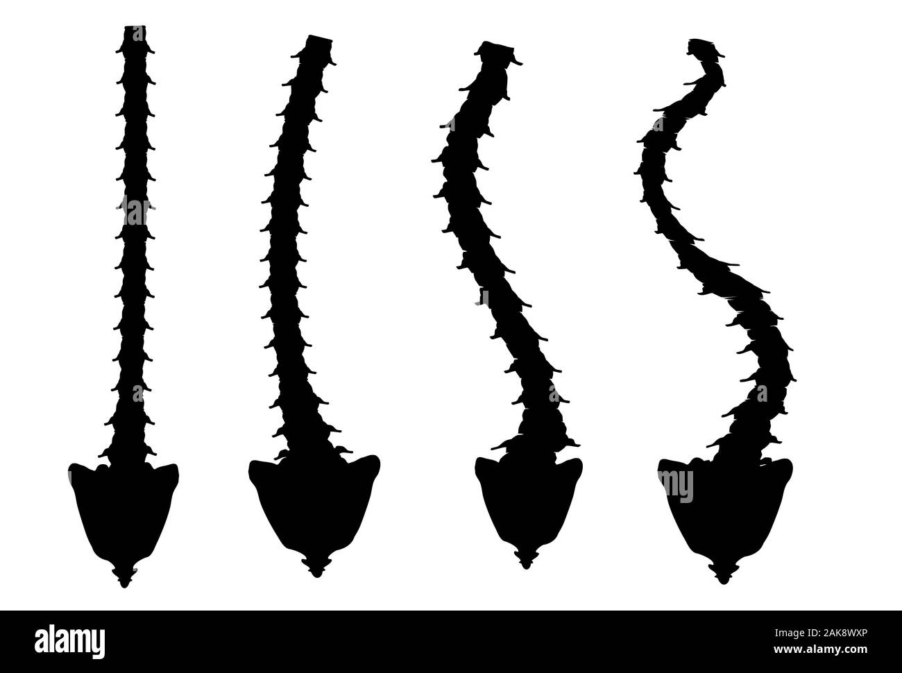 Tipi di scoliosi. C, S, a forma di Z la scoliosi. Dextroscoliosis ...