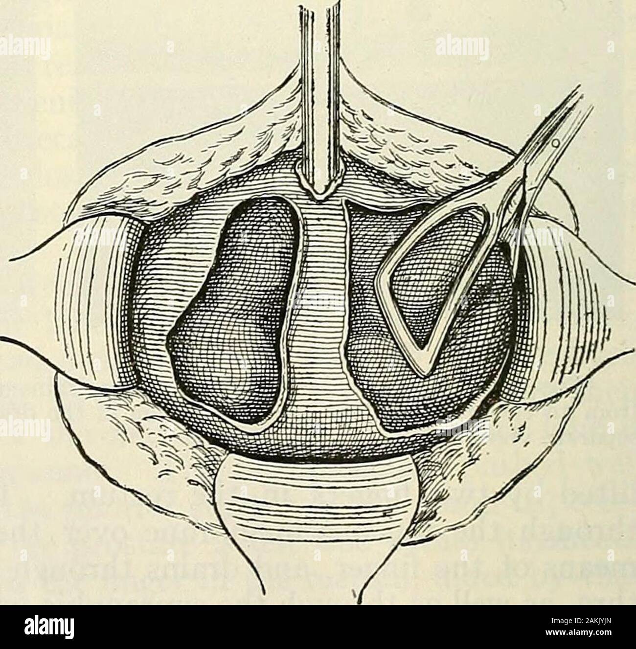 La moderna chirurgia generale e operativo . Fig. 933.-Trattore ...