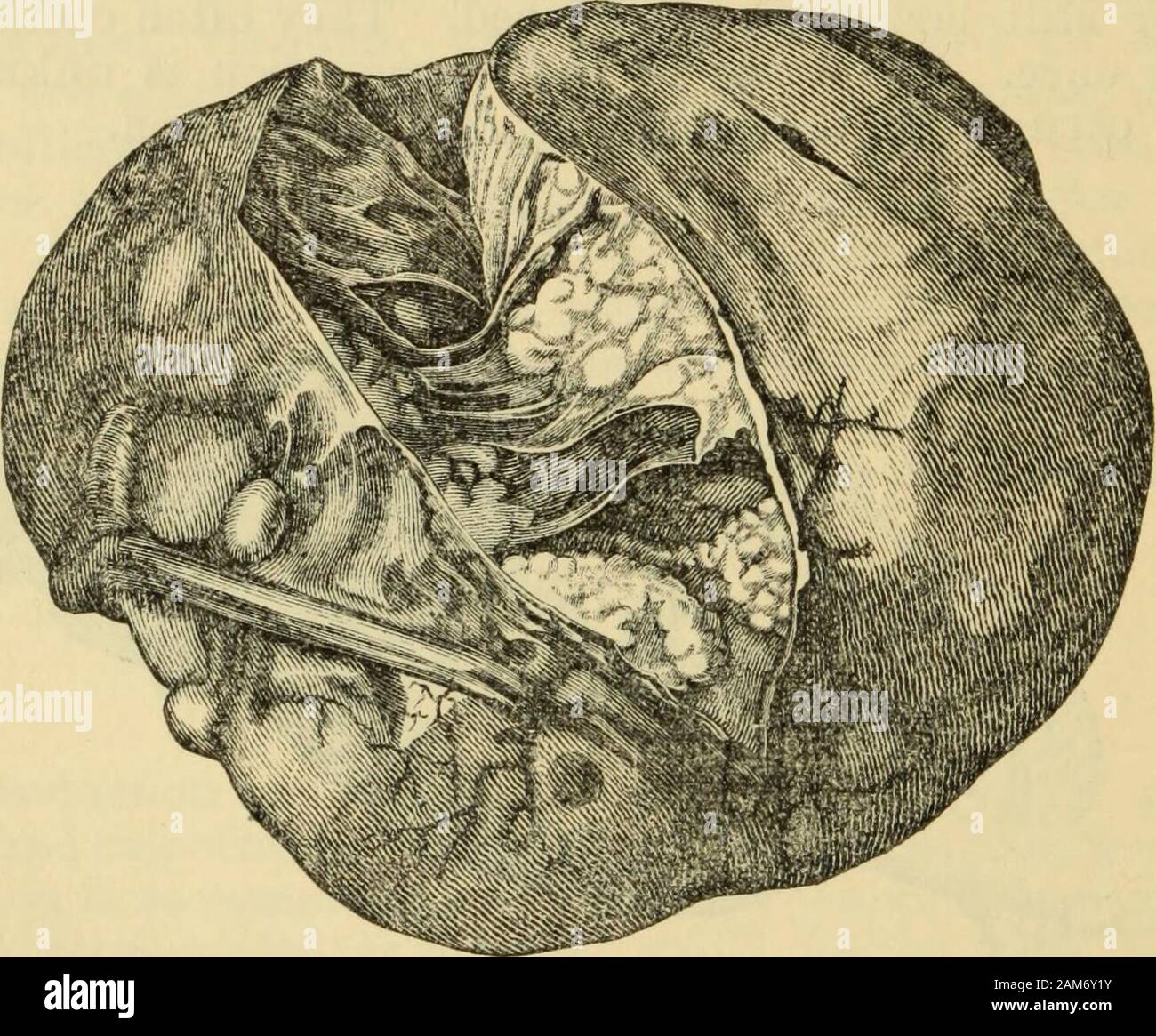 Cisti della tuba di falloppio immagini e fotografie stock ad alta ...