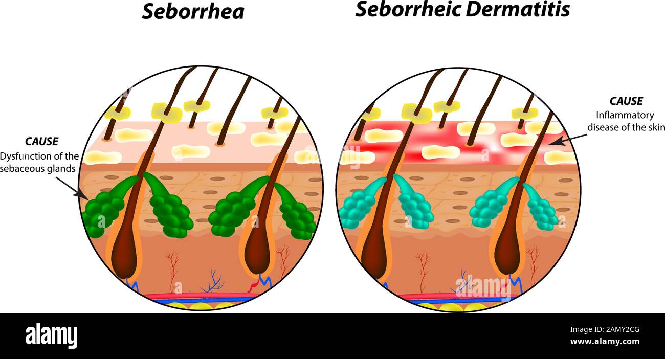 Provoca Seborrea pelle e capelli. Dermatite seborroica da forfora ...