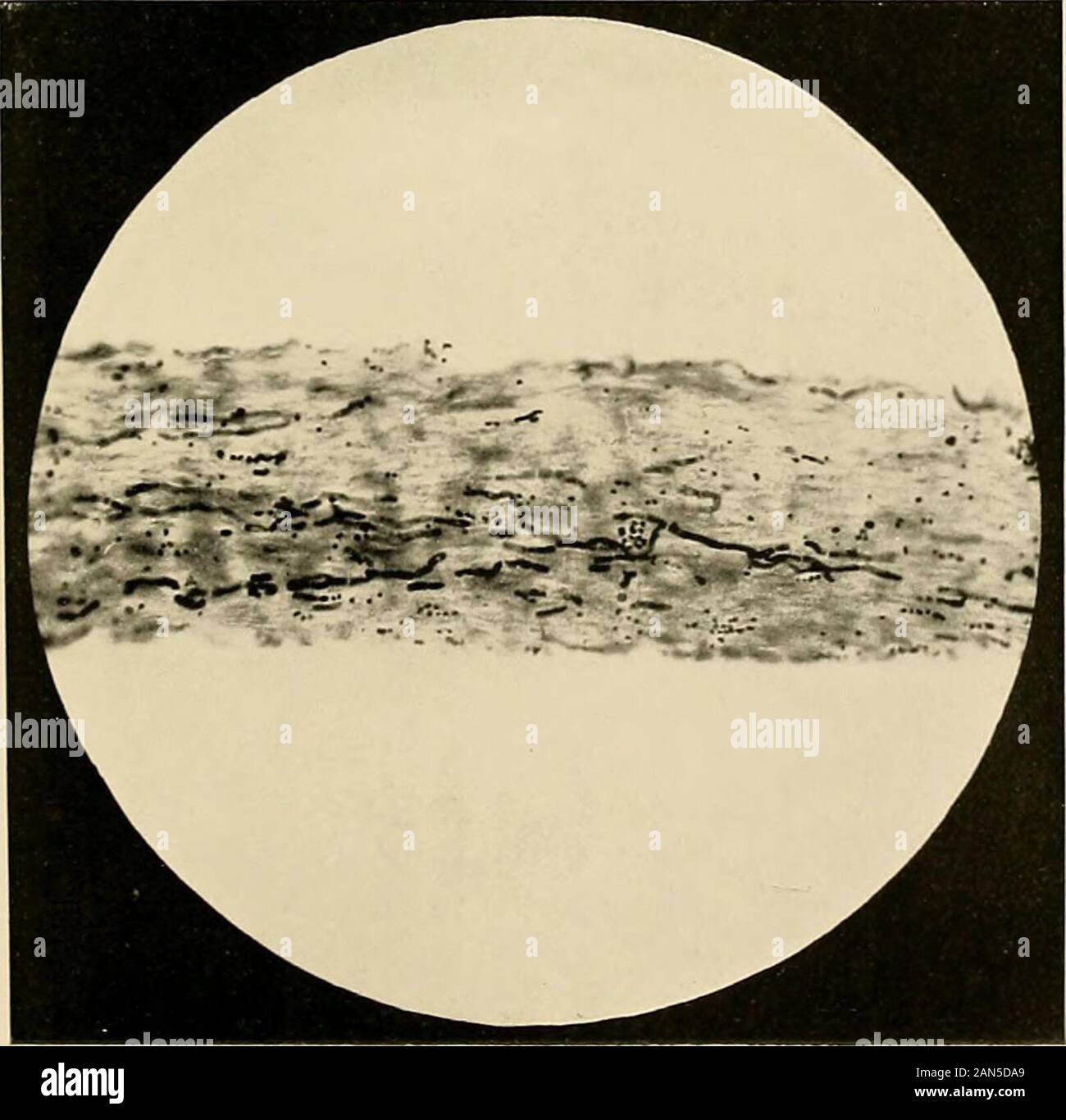 Ringworm of the scalp immagini e fotografie stock ad alta risoluzione ...