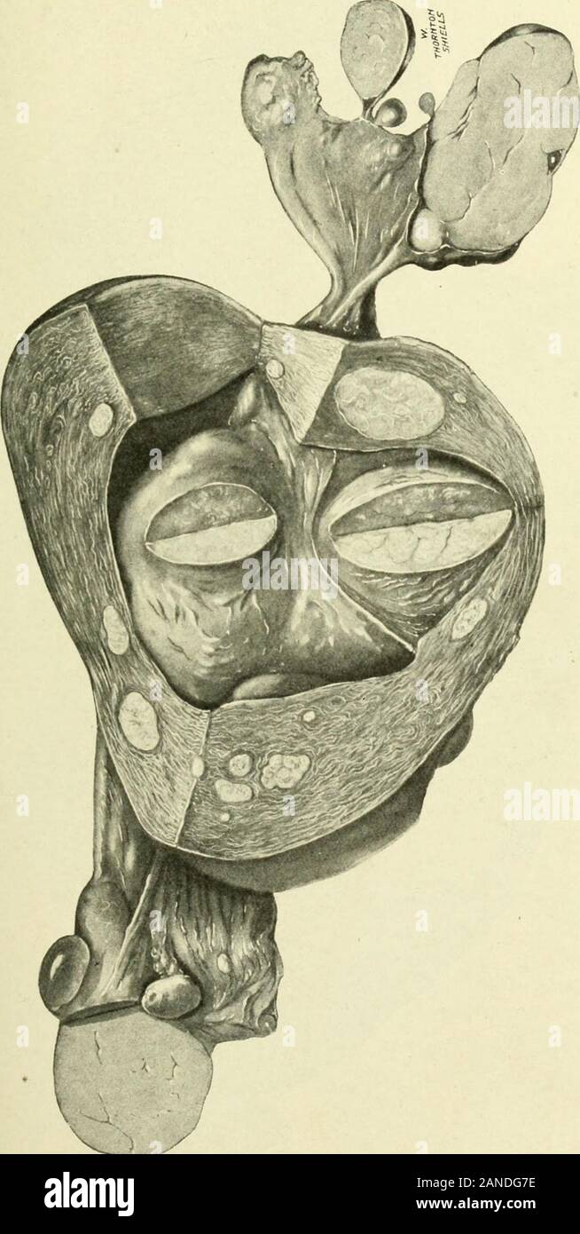 Legamento largo utero immagini e fotografie stock ad alta risoluzione ...