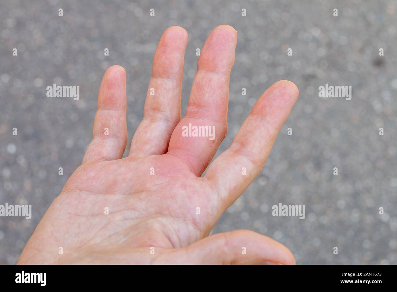 Dito medio gonfio immagini e fotografie stock ad alta risoluzione - Alamy