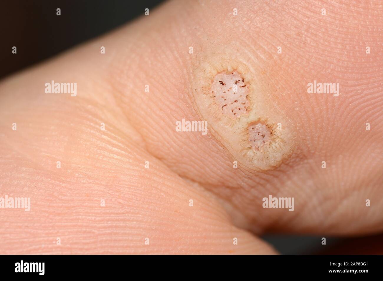 Verruca virale immagini e fotografie stock ad alta risoluzione - Alamy
