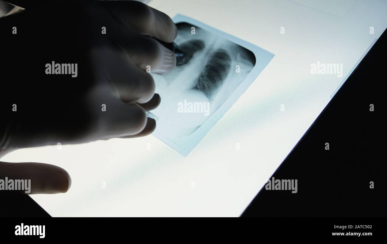 Controllo medico sui raggi X del torace. Uomo che tiene la radiografia ...